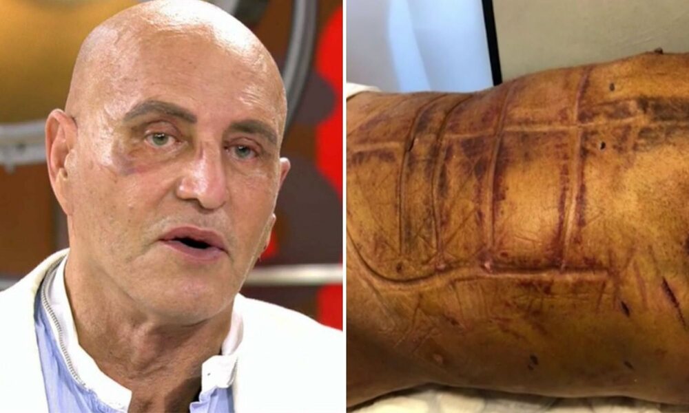 Kiko Matamoros muestra el impactante resultado de sus tres nuevas ...